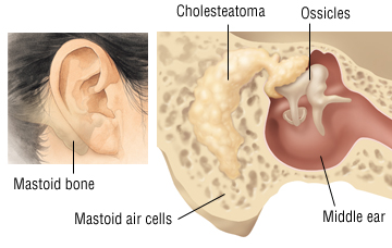 Cholesteatoma and other Chronic Ear Problems - MPENTA
